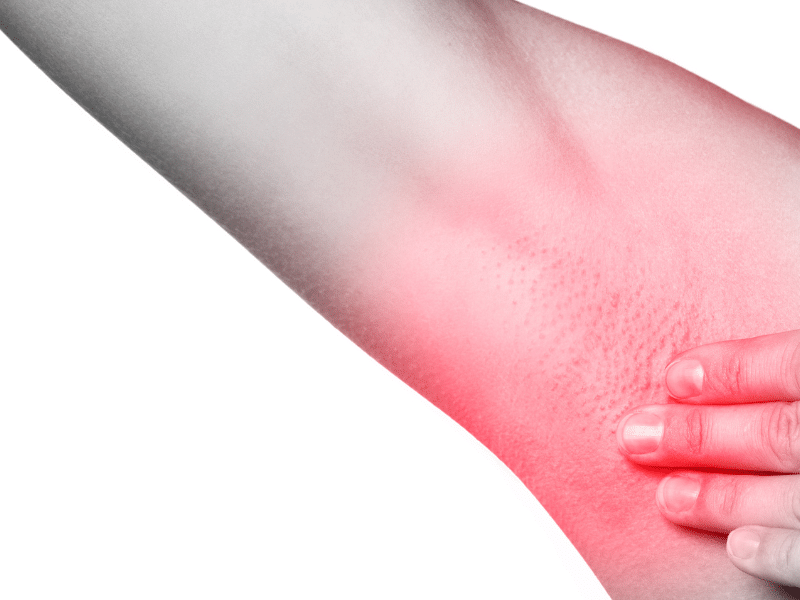 10 Cause di Irritazione Ascellare, Spiegate dai Dermatologi - JeFemme.it